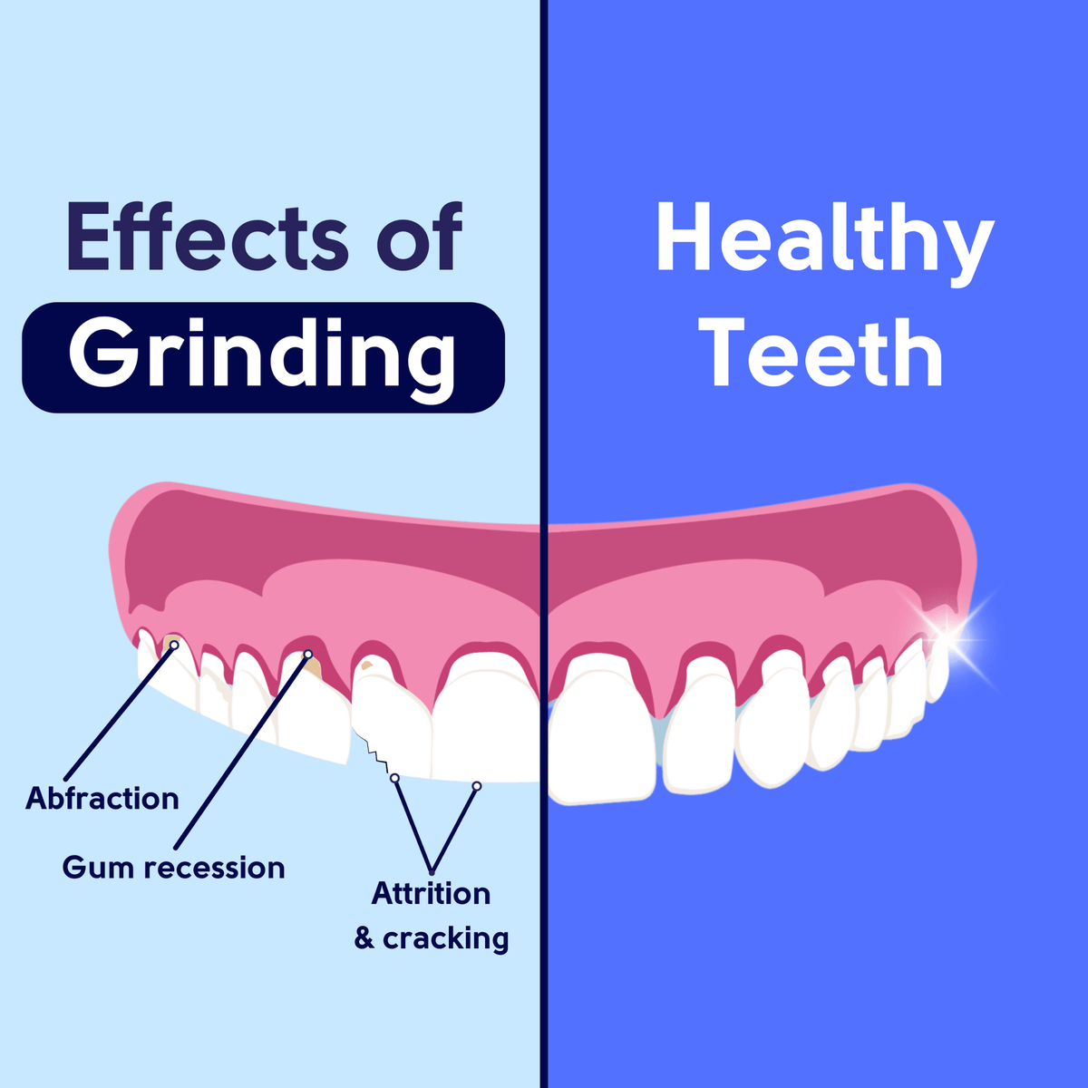 Night Guard for Teeth Grinding & Clenching | GrindGuard™ Plus